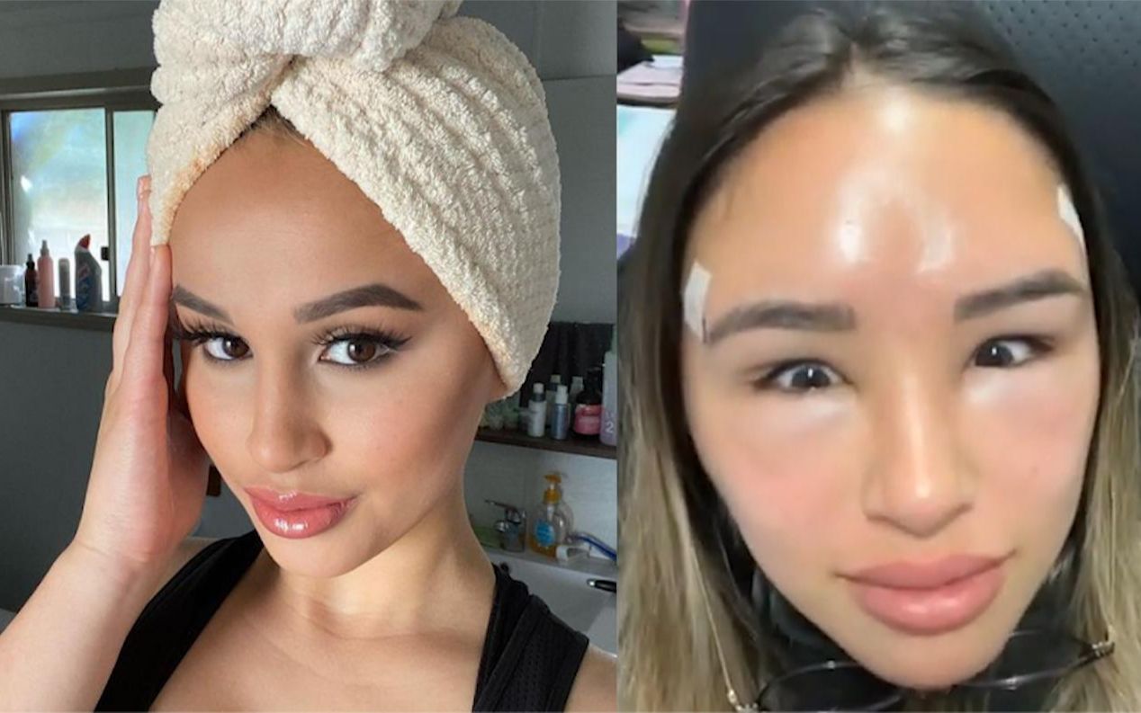 Outrageous: Woman Undergoes Surgery to Get Slanted “Danfeng” Eyes Just ...