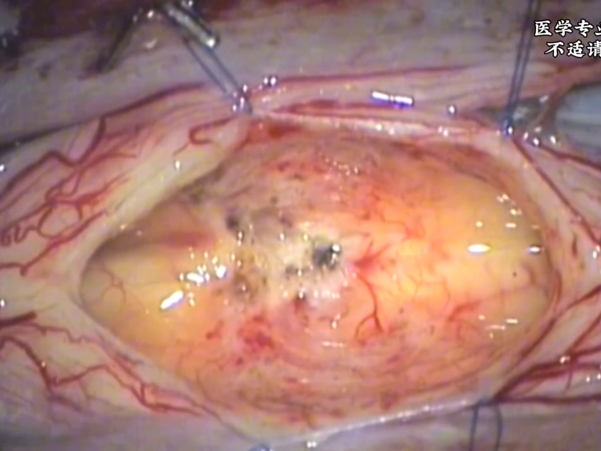 Spinal Tumor Removal Surgery (Surgical Video—Not for the Non ...